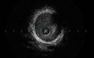 Intravascular Ultrasound Guided PCI | HDi HD IVUS & Catheter System ...